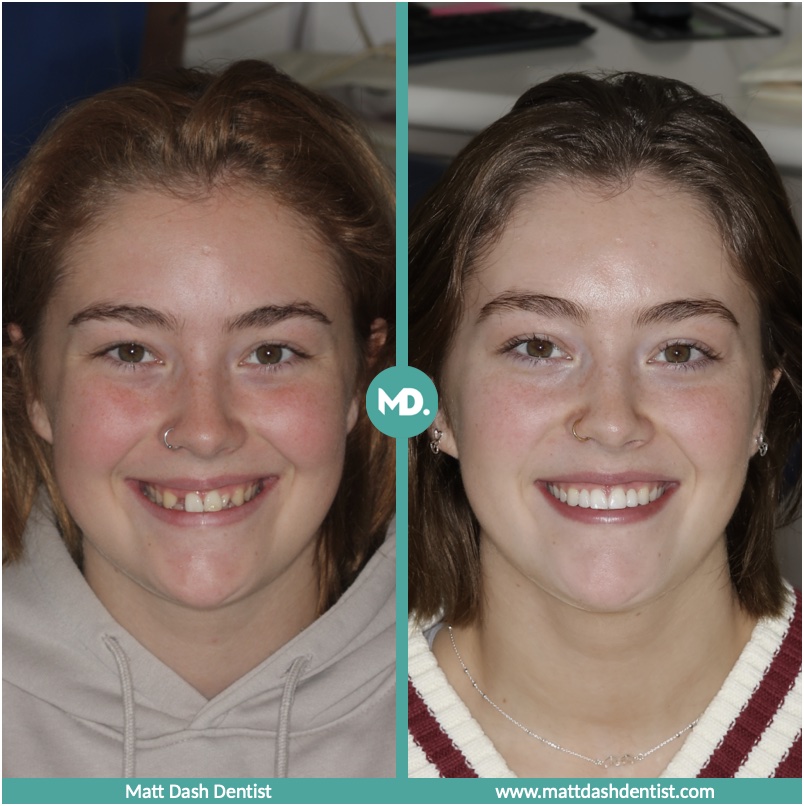 Smile Makeover (Tooth Whitening - Porcelain Bridges - Composite Bonding ...