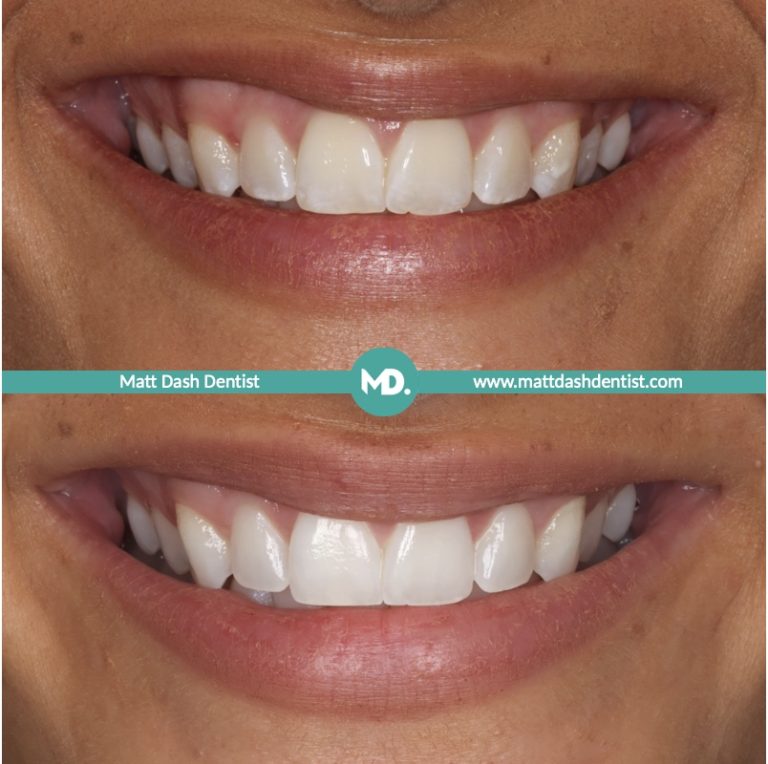 White Patches After Braces? Here's What You Need To Know - Matt Dash ...