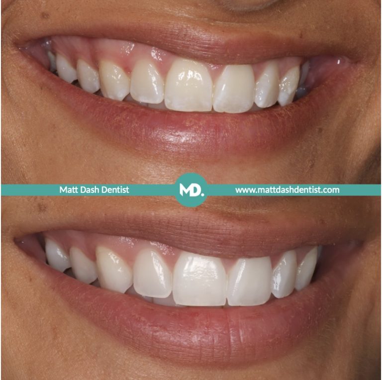 White Patches After Braces? Here's What You Need To Know - Matt Dash ...