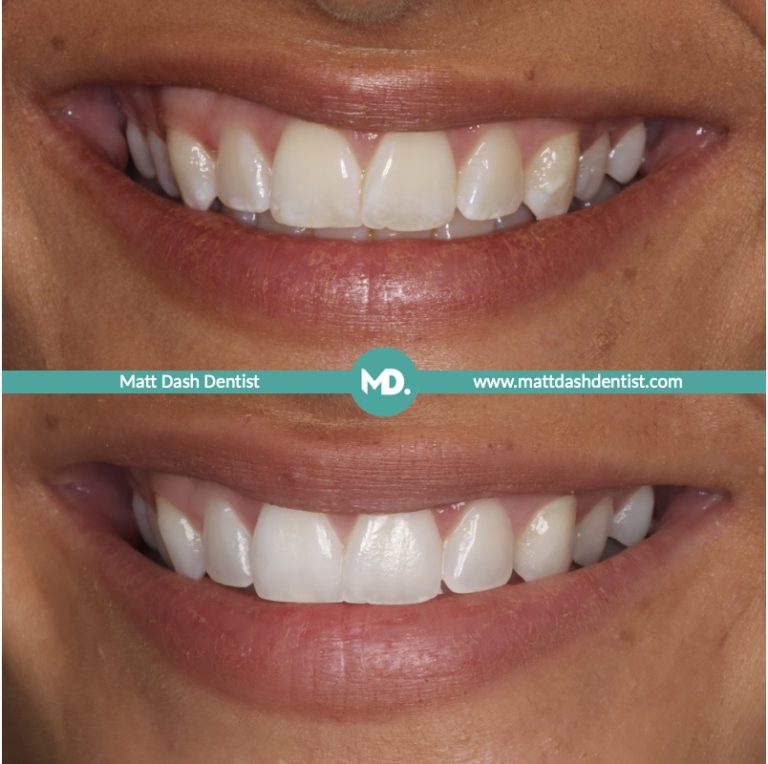 White Patches After Braces? Here's What You Need To Know - Matt Dash ...
