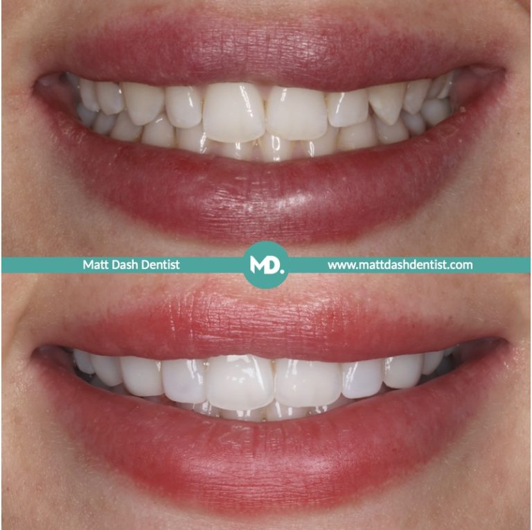 Why Are My Canine Teeth Pointy? Understanding Your "Eye Teeth" - Matt ...