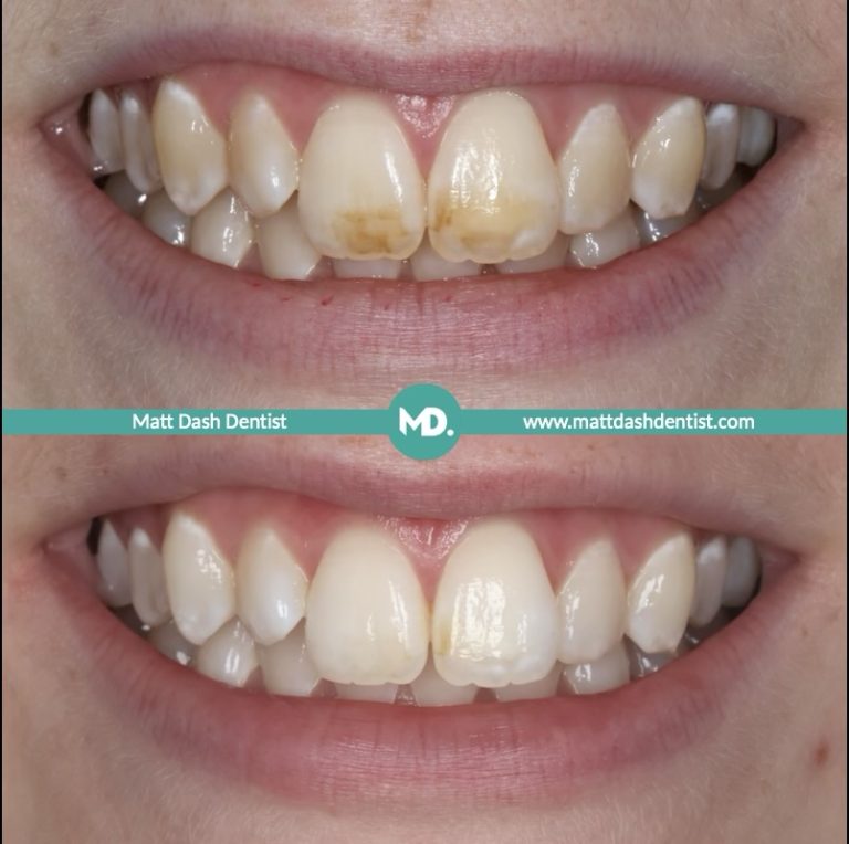 Brown Spots on Teeth – What They Are and What You Can Do - Matt Dash ...