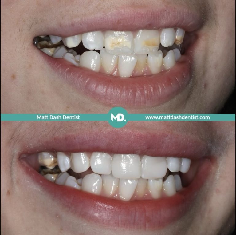 Brown Spots on Teeth – What They Are and What You Can Do - Matt Dash ...