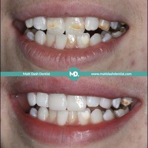 Brown Spots on Teeth – What They Are and What You Can Do - Matt Dash ...