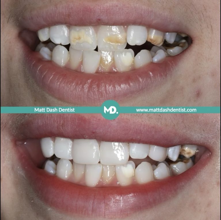 Brown Spots on Teeth – What They Are and What You Can Do - Matt Dash ...